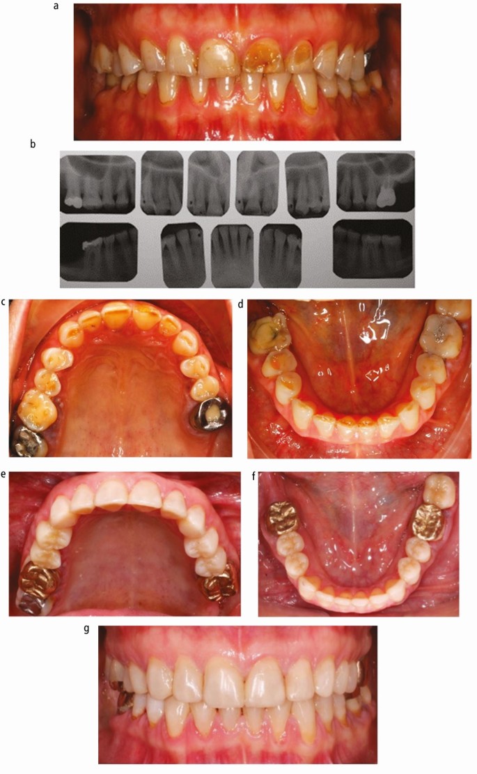The survival and clinical performance of anterior composite resin ...