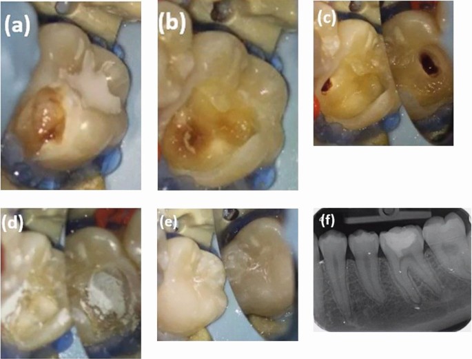 Successful partial pulpotomy of a permanent mandibular molar: a two ...