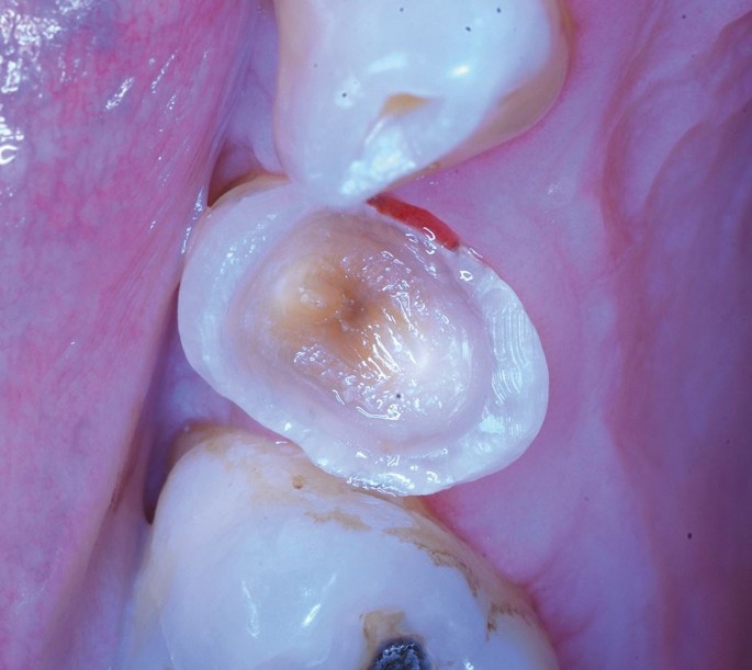 Vital pulp therapies in permanent teeth: what, when, where, who, why ...