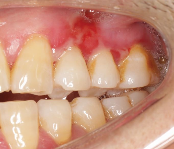 Oral and penile mucous membrane pemphigoid | British Dental Journal