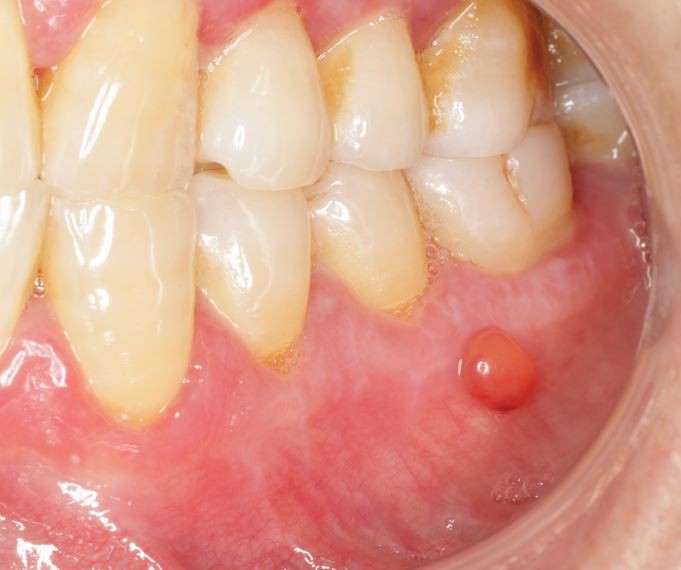 Oral and penile mucous membrane pemphigoid | British Dental Journal