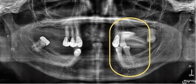 New ghost image on OPG | British Dental Journal