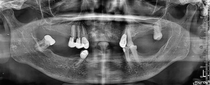 New ghost image on OPG | British Dental Journal