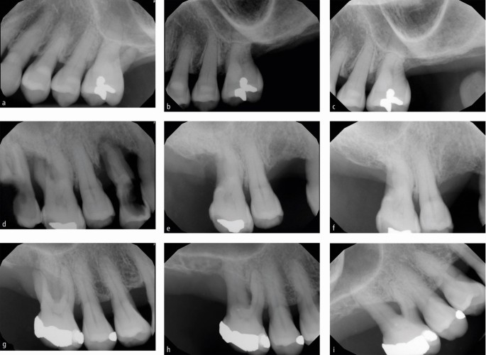 Single-visit vital root resection and retrograde pulpotomy for ...