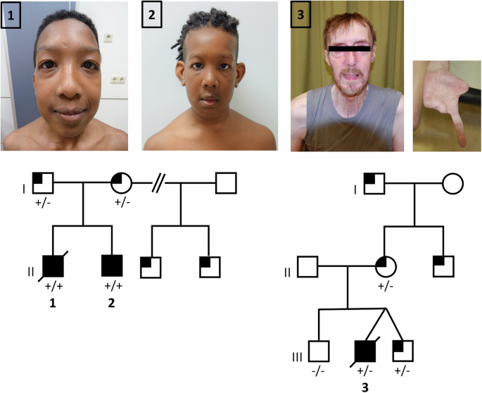 Biallelic and monoallelic variants in EFEMP1 can cause a severe and ...