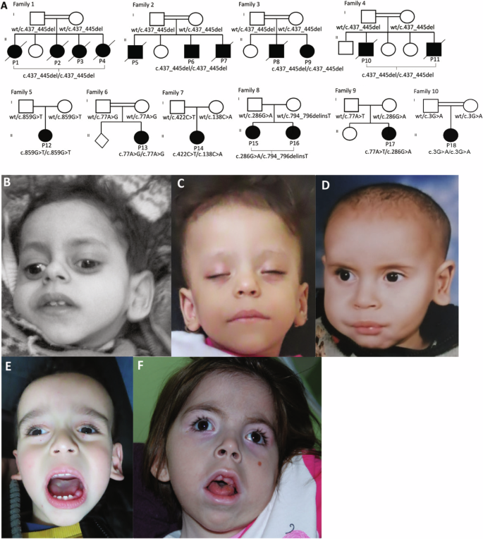 PIGC-related encephalopathy: Lessons learned from 18 new probands ...