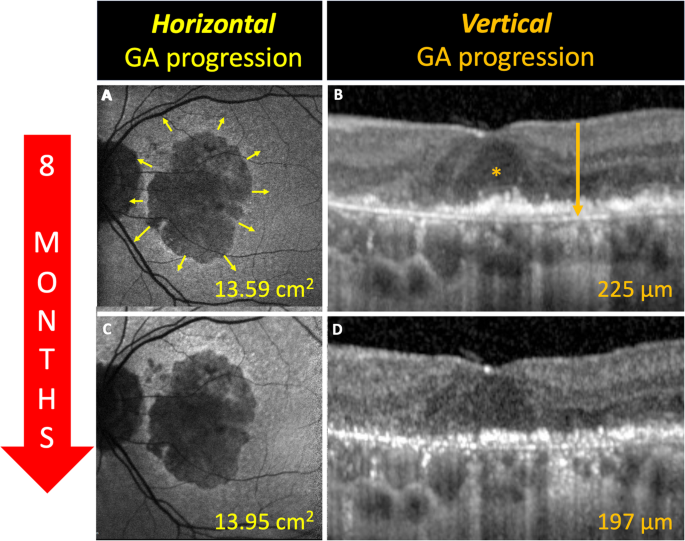 Vertical and horizontal geographic atrophy – A concept to overcome the ...