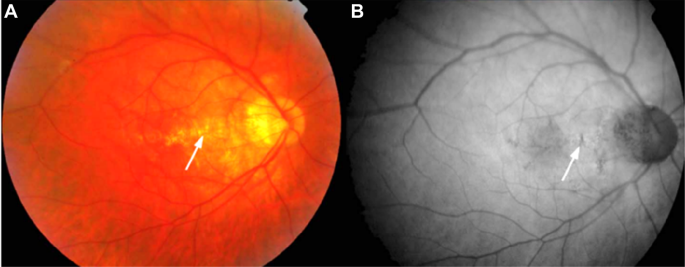 Lacquer cracks in pathological myopia: a clinical review | Eye