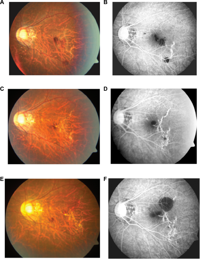 Lacquer cracks in pathological myopia: a clinical review | Eye
