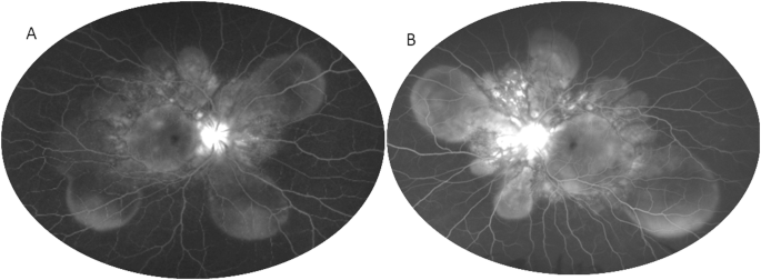 Water balloon appearance in fundus | Eye