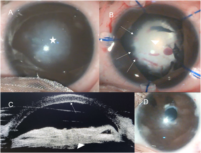 Persistent foetal vasculature masquerading as Peters anomaly | Eye