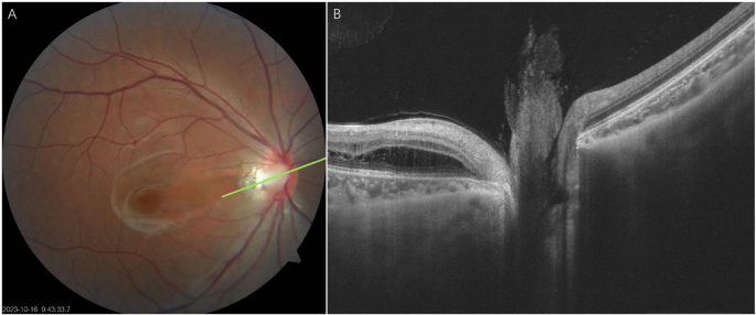 Bergmeister papilla with optic disc pit maculopathy | Eye