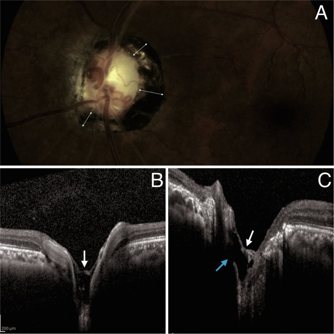 A cup within a cup | Eye