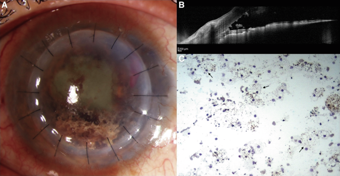 A flocculent iris? | Eye