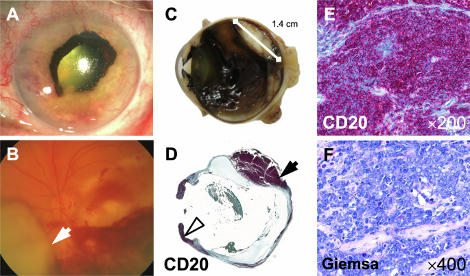 Intraocular manifestation of a diffuse large B-cell non-Hodgkin ...