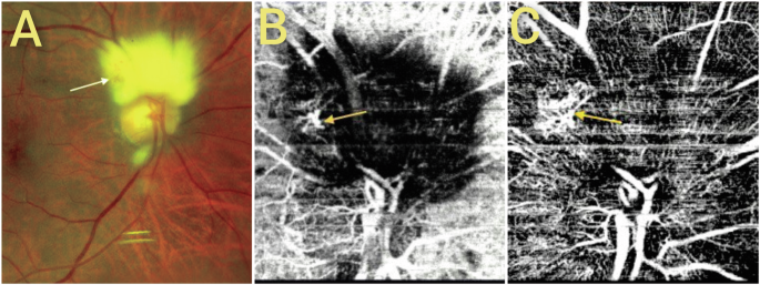 Neovascularization beneath myelinated nerve fibres: a multimodal ...