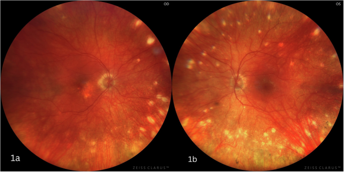 Sunset glow fundus with Dalen-Fuchs nodules in chronic Vogt-Koyanagi ...