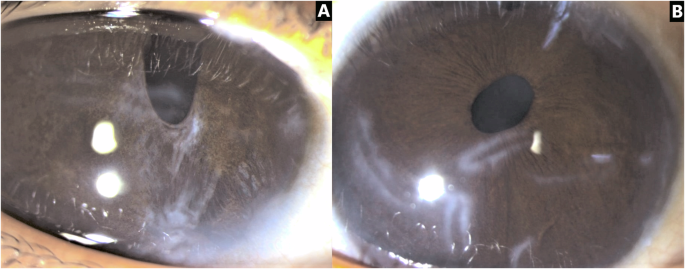 Haab’s striae sans buphthalmos | Eye