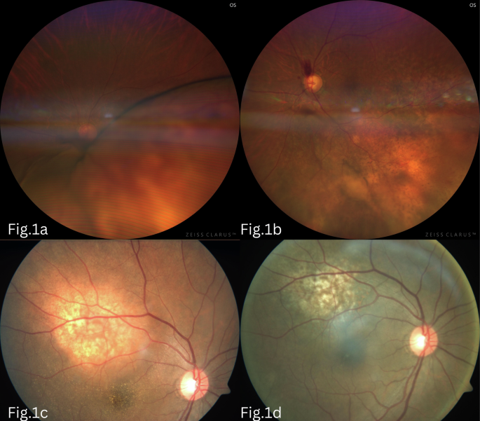 Choroidal metastases secondary to lung carcinoma: photo essay | Eye