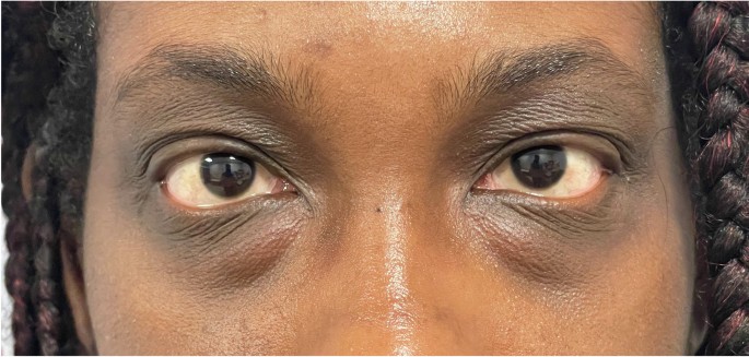 Identifying the root cause of lost lashes | Eye