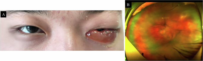 Acute retinal necrosis presenting as severe inflammatory orbitopathy | Eye