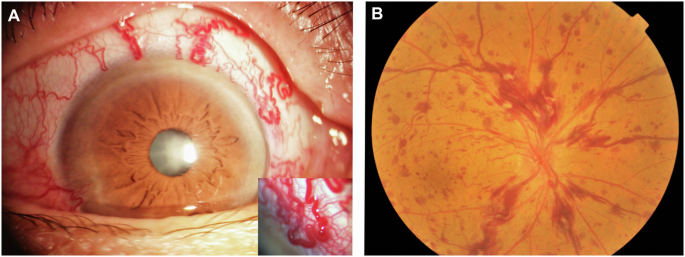 Tortuous conjunctival vessels and central retinal vein occlusion in ...