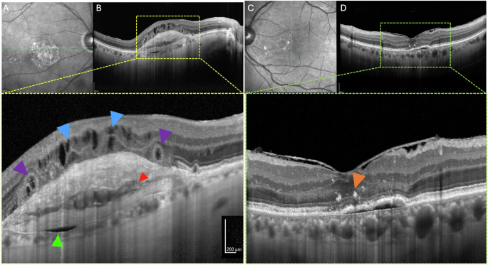 Non-exudative OCT findings in neovascular AMD | Eye