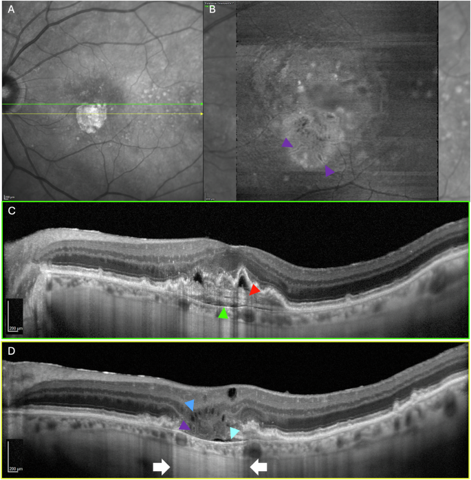 Non-exudative OCT findings in neovascular AMD | Eye