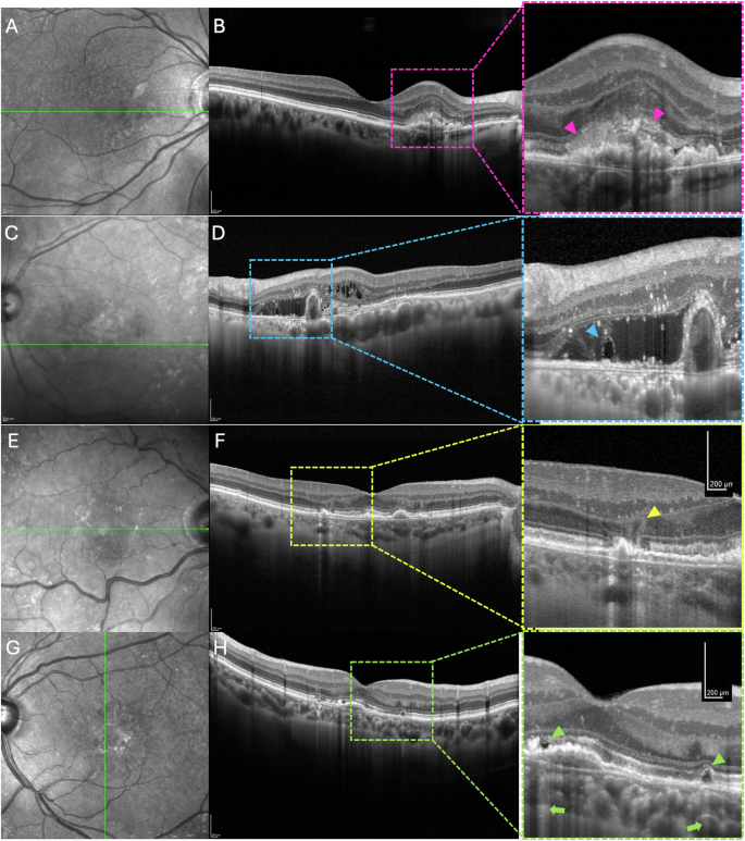 Non-exudative OCT findings in neovascular AMD | Eye