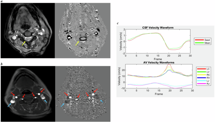 Non-invasive assessment of intracranial compliance in idiopathic ...