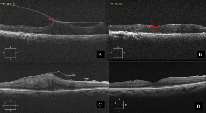 Vitreomacular traction – a review | Eye