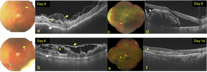 Evolution of annular exudative retinal detachment in acute retinal ...