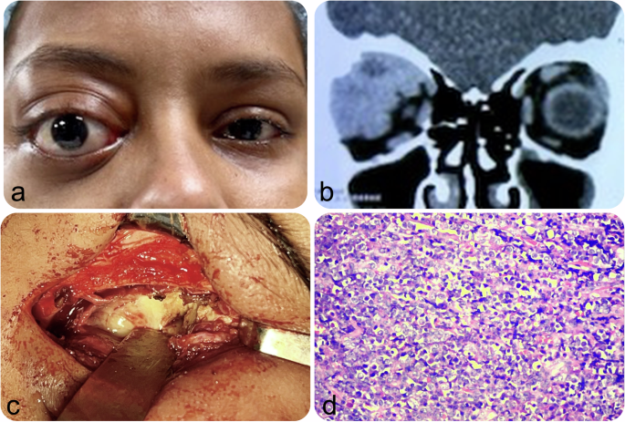 Orbital chloroma mimicking as idiopathic orbital inflammatory disease | Eye