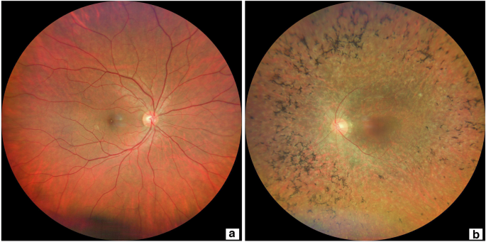 Unilateral retinitis pigmentosa | Eye