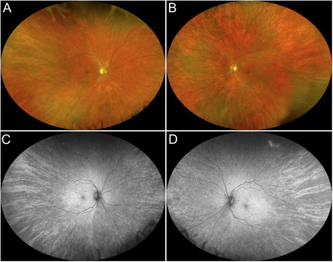 Mud-splattered pattern of retinal pigmentation in carrier of ocular ...