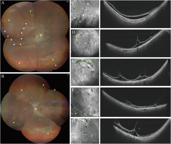 Bilateral peripheral retinoschisis with vitreous retinal traction | Eye