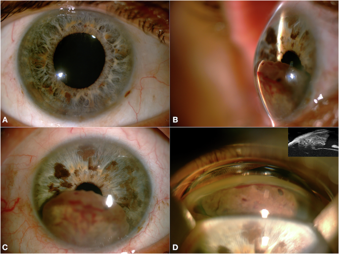 Iris melanoma in an Asian Indian with multifocal iris nevi | Eye