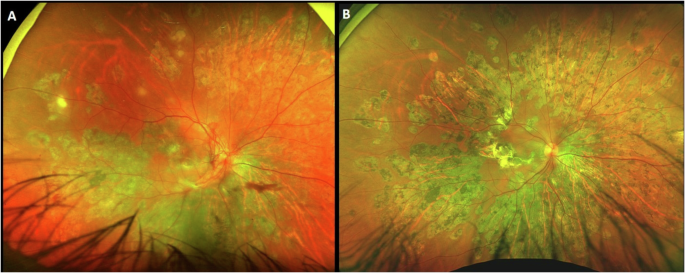 Kaleidoscope of ocular tuberculosis | Eye