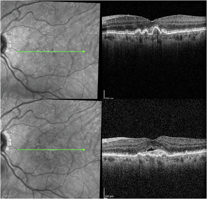 Updates on novel and traditional OCT and OCTA biomarkers in nAMD | Eye