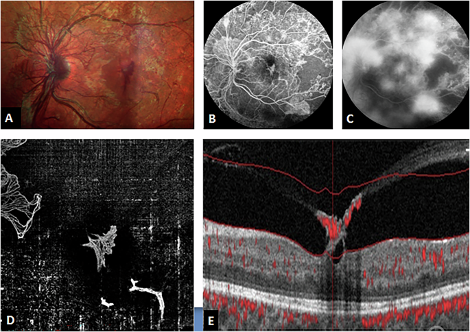 Diabetic foveal neovascularization is associated with diminished ...
