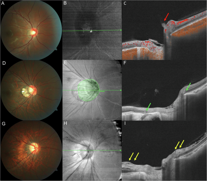 Clinical features of high myopia with optic nerve head prelaminar ...