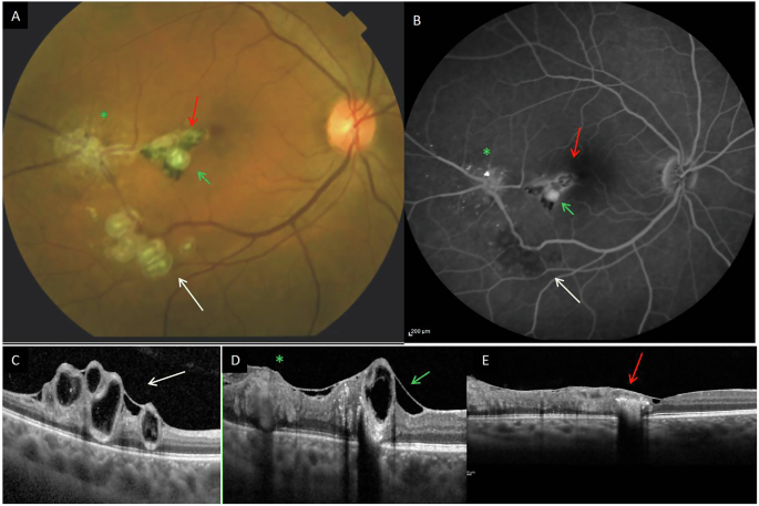Hyalinised pearls: atypical retinal cavernous haemangioma | Eye