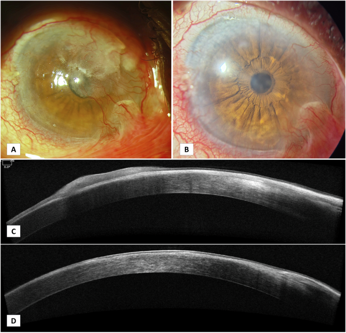 Rapid remission of extensive corneal surface neoplasia with topical ...