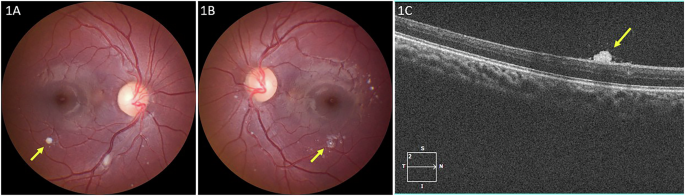 Pre-retinal deposits in Type 1 Gaucher disease | Eye