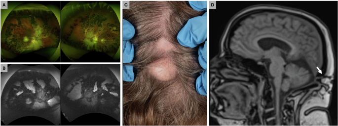 Beware the midline scalp lump in a patient with retinal dystrophy | Eye