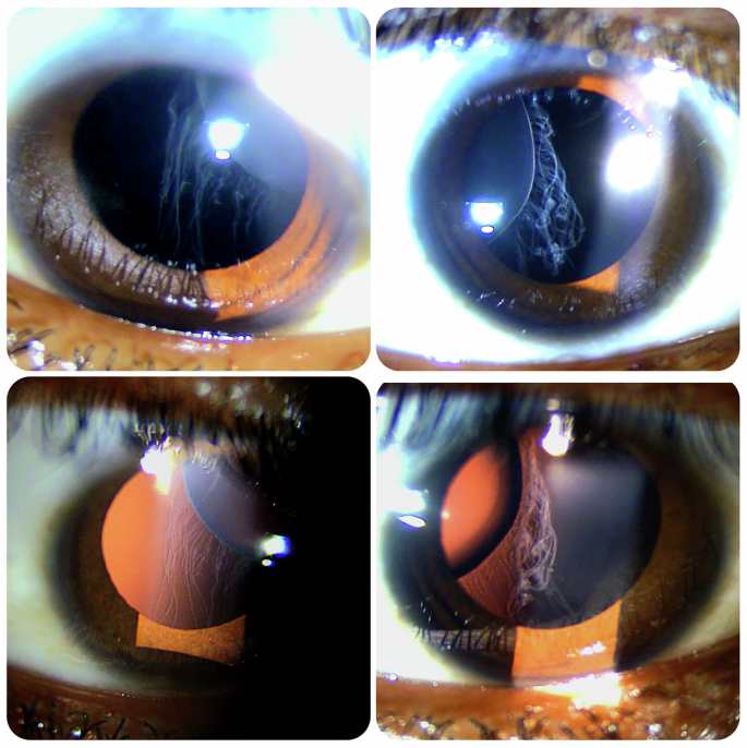 Visible zonular breaks in Marfan related ectopia lentis | Eye