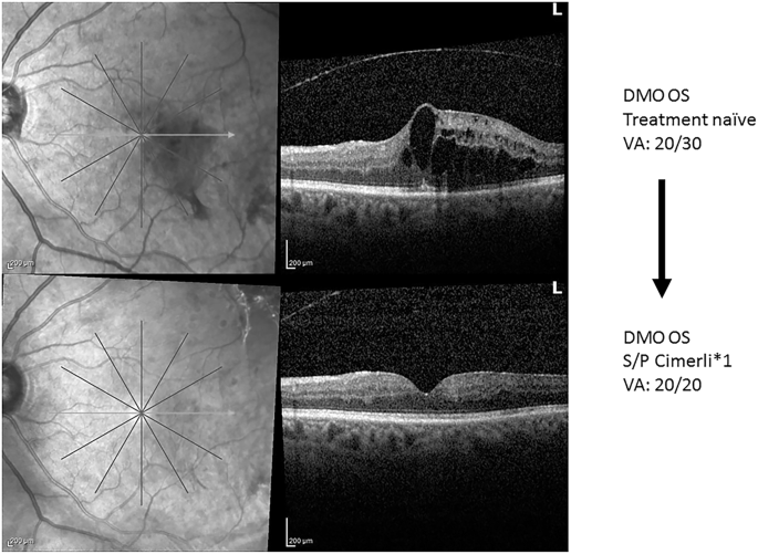 FYB-201 Biosimilar ranibizumab (Ongavia/Ranivisio/Cimerli) Efficacy and ...