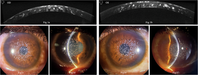 Starry sky appearance of type 1 granular corneal dystrophy | Eye