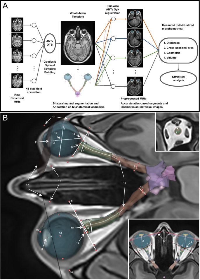 MReye-Seg: development and validation of an automated MRI pipeline for ...