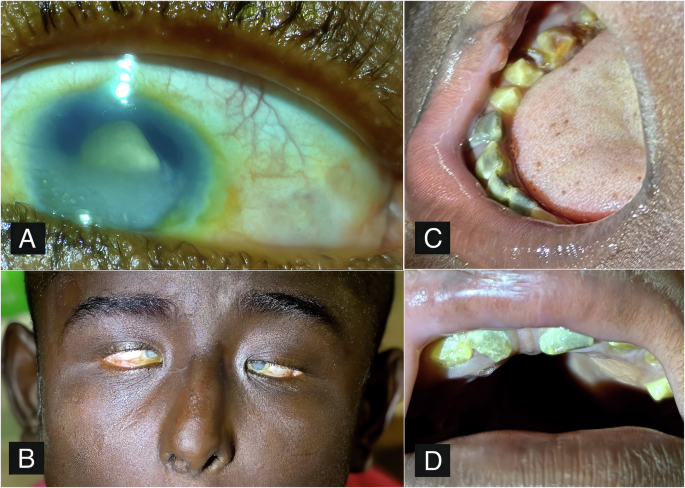A paediatric case of Nance–Horan Syndrome | Eye